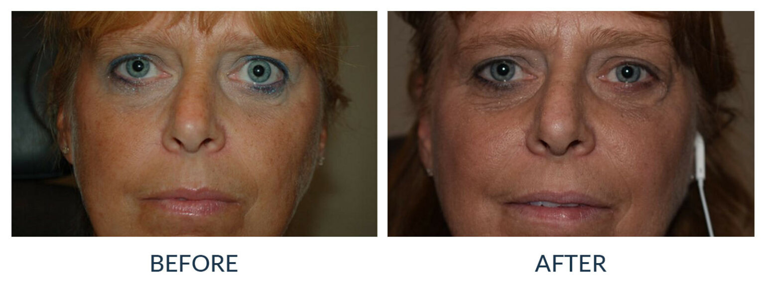 Lower Lid Retraction | Vermont Cosmetic Eye