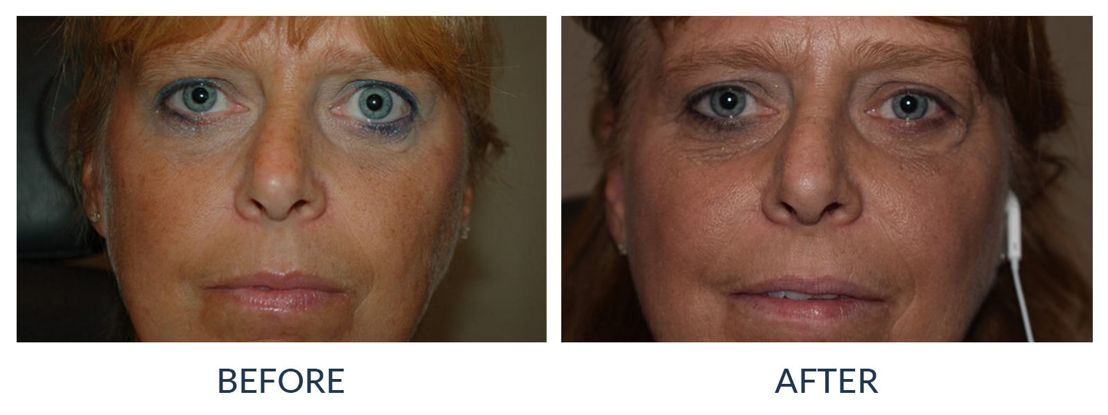 Lower Lid Retraction | Vermont Cosmetic Eye